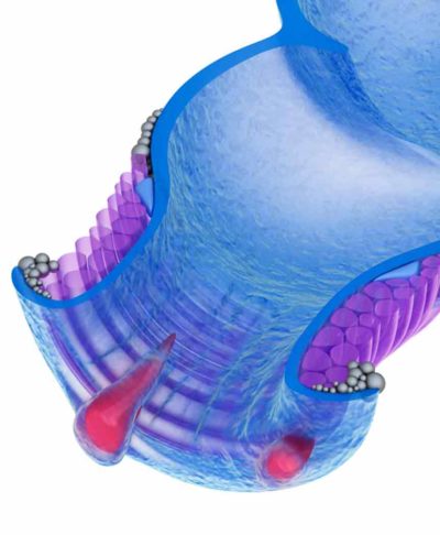 THD Treatment - Colorectal and Gastro Clinic | Colon Cancer ...