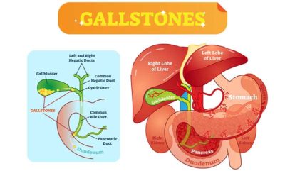 Gallstones - Colorectal and Gastro Clinic | Colon Cancer | Colonoscopy ...
